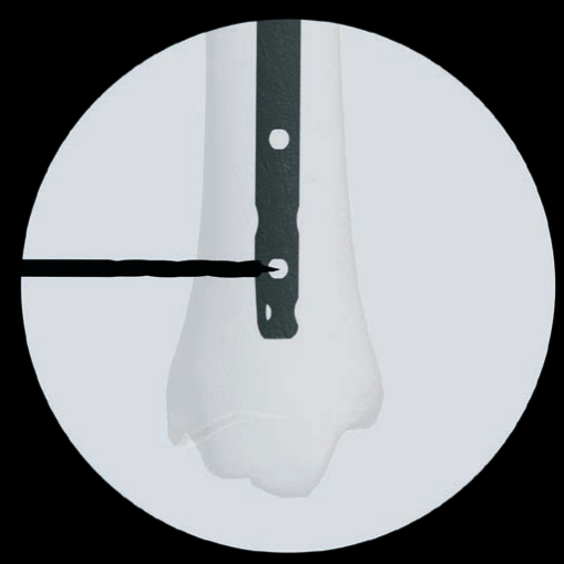 CRIF IM nail tibia - Dr.D : 네이버 블로그