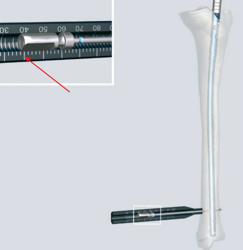 CRIF IM nail tibia - Dr.D : 네이버 블로그
