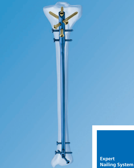 CRIF IM nail tibia - Dr.D : 네이버 블로그