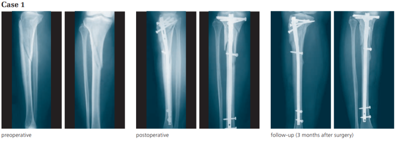 CRIF IM nail tibia - Dr.D : 네이버 블로그