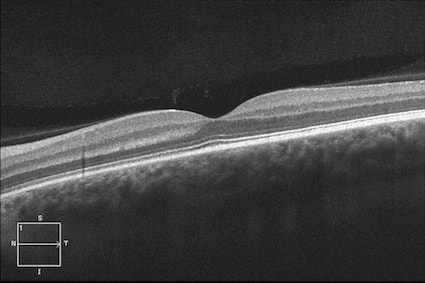 [안과의사가 말하는 안과질환] solar retinopathy, photic maculopathy, 태양/레이저을 보고 시력이 ...