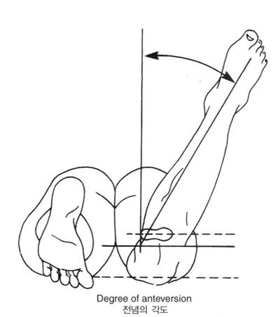 ‘전경(anteversion)/후경(retroversion)’, ‘전념(antetorsion)/후념(retrotorsion ...