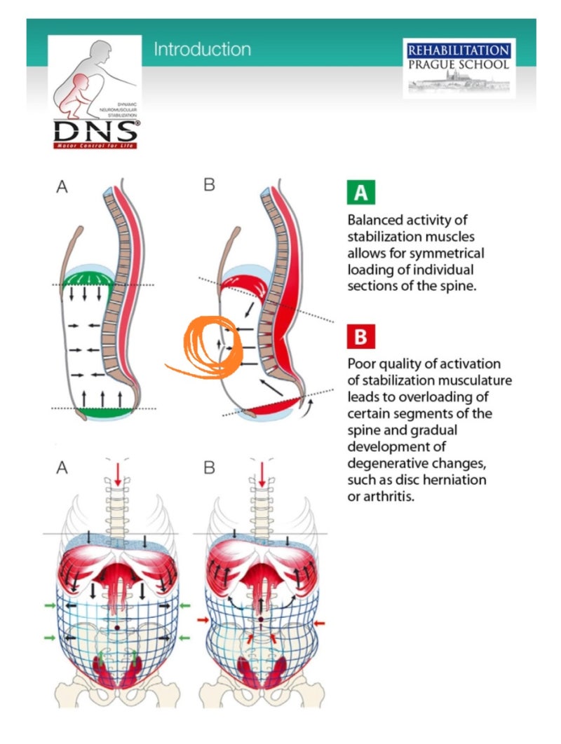 척추협착증(Spinal Stenosis) 회원에게 DNS운동 적용 리뷰 : 네이버 블로그