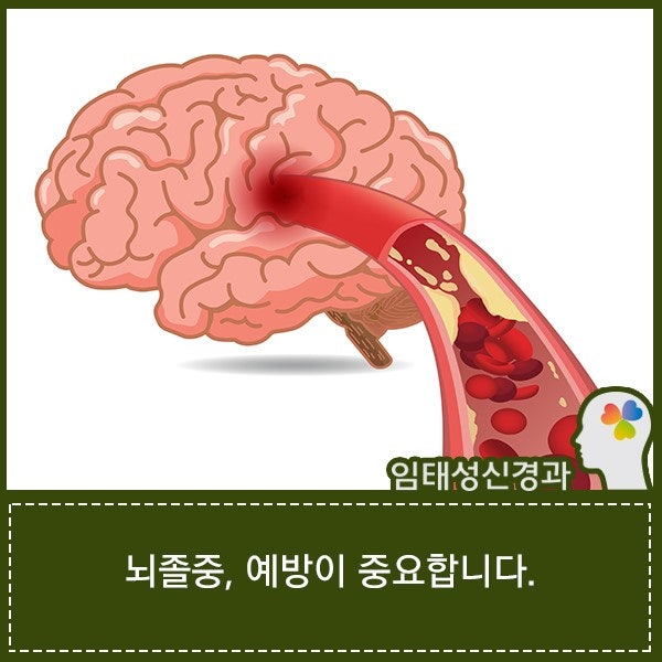수원 신경과 추천 뇌혈류초음파검사 Tcd 란 네이버 블로그