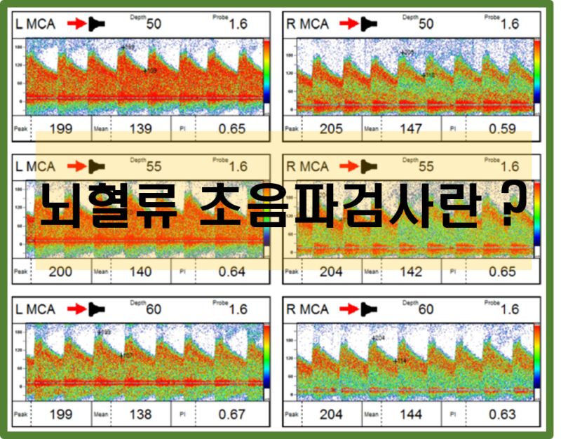 수원 신경과 추천 뇌혈류초음파검사 Tcd 란 네이버 블로그