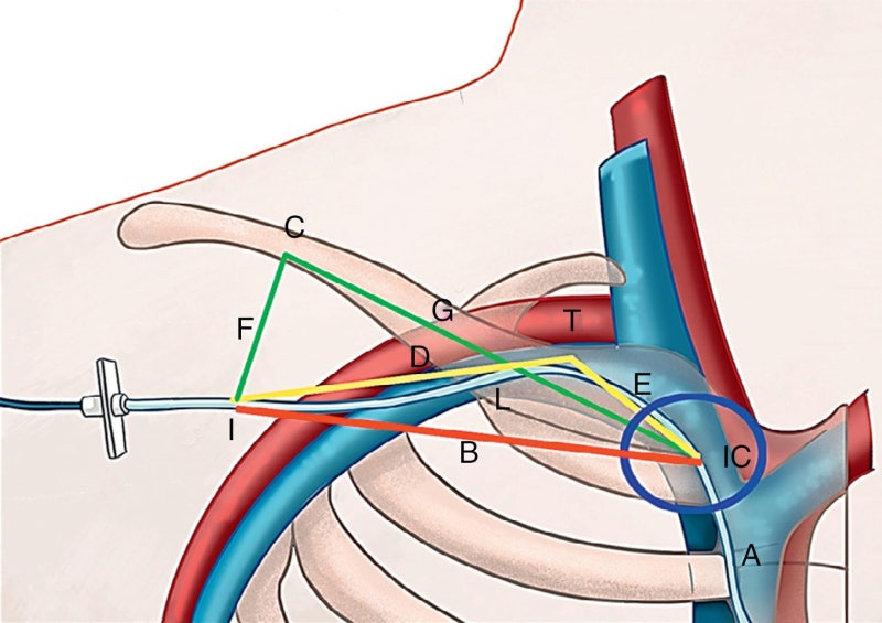 sono guided subclavian vein C-line insertion : 네이버 블로그