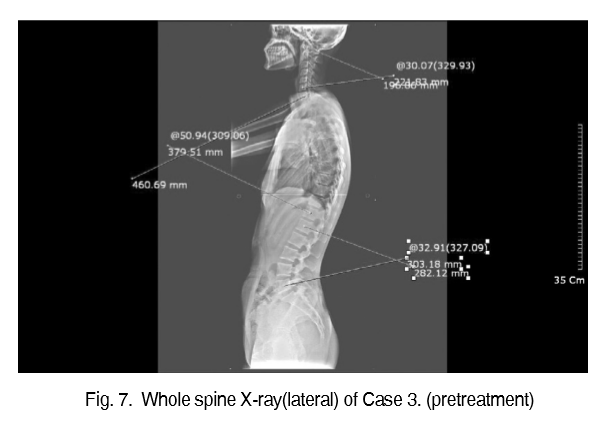[논문/체형] 운동 치료 및 MET를 통한 sway back(굽은등) 체형 치험 증례 : 네이버 블로그