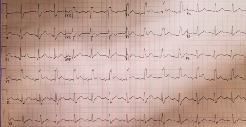 우각차단 심전도에서 심근경색 진단, Acute myocardial infarction in right bundle branch ...