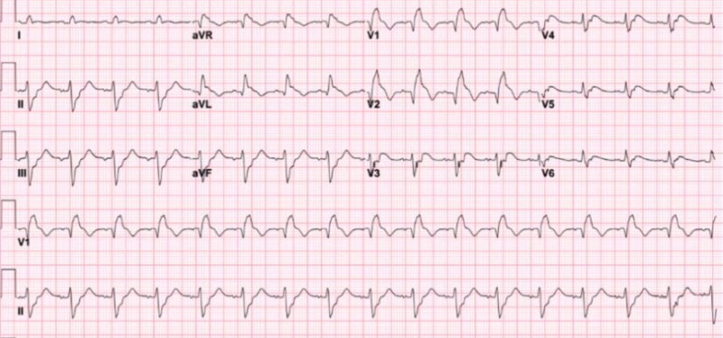 우각차단 심전도에서 심근경색 진단, Acute myocardial infarction in right bundle branch ...