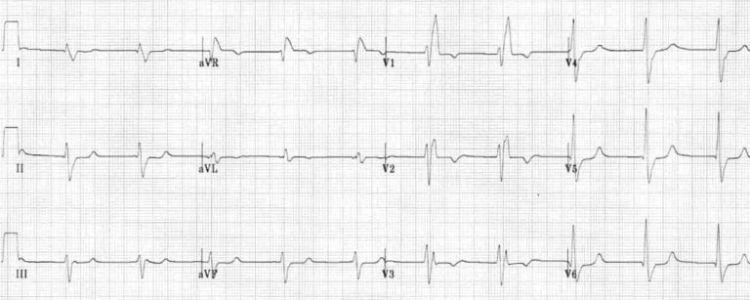 우각차단 심전도에서 심근경색 진단, Acute myocardial infarction in right bundle branch ...