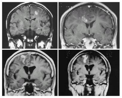 스파르가눔(Sparganum)증 : 네이버 블로그