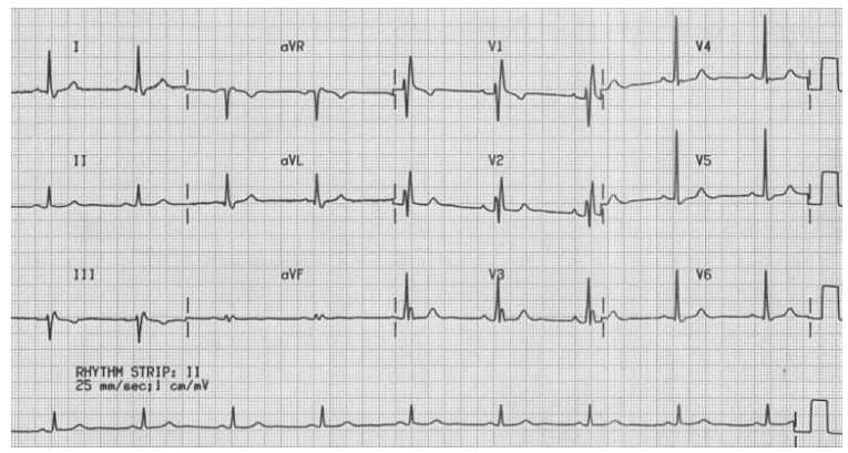 우각차단 심전도에서 심근경색 진단, Acute myocardial infarction in right bundle branch ...