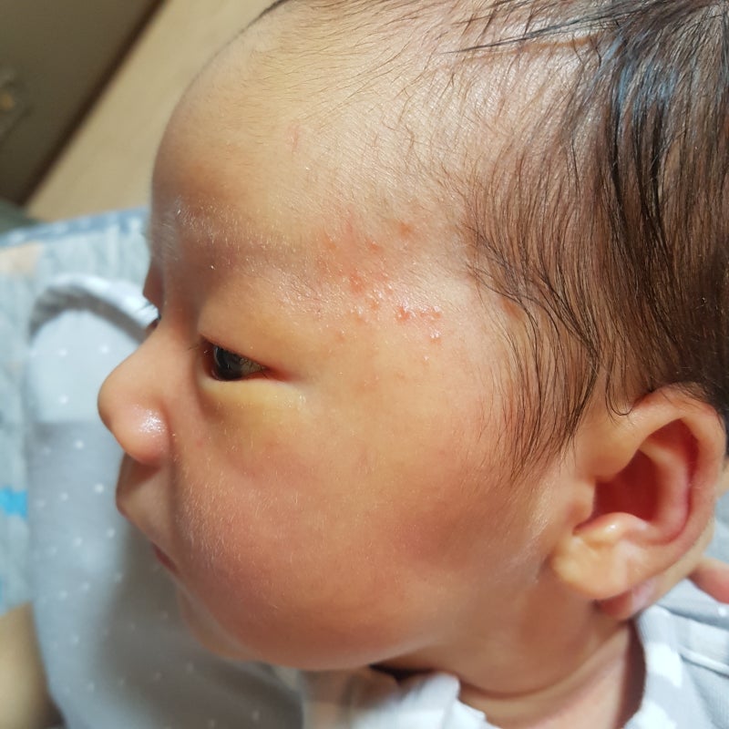 신생아 지루성피부염 리도멕스로션 아기 두피각질 네이버 블로그