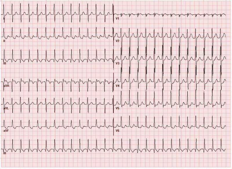 PSVT, 3 가지 경우 ① ② ③ : 네이버 블로그