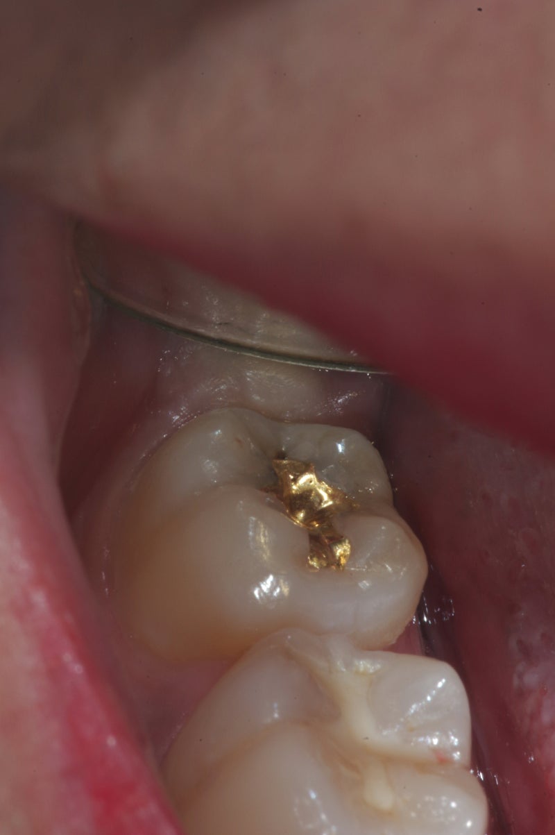 mta로 될지, 신경치료해야할지, 크라운할지, 온레이할지 치과의사도 모릅니다. : 네이버 블로그