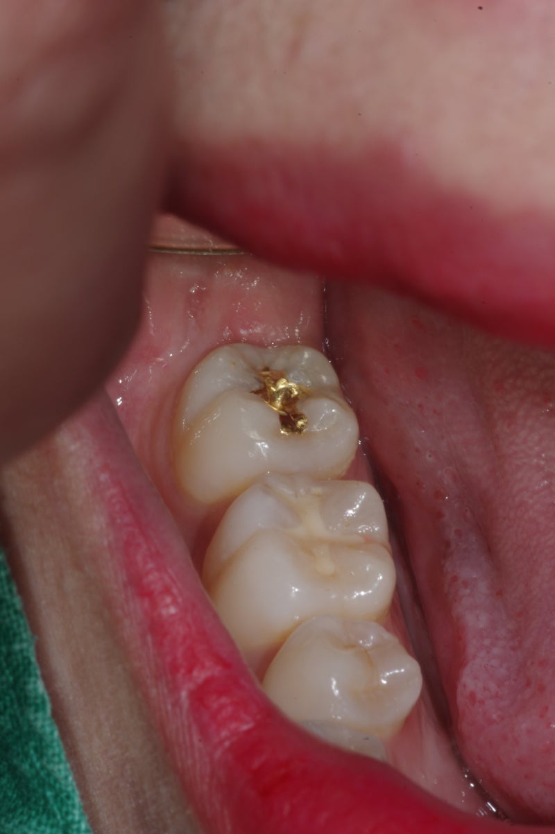 mta로 될지, 신경치료해야할지, 크라운할지, 온레이할지 치과의사도 모릅니다. : 네이버 블로그