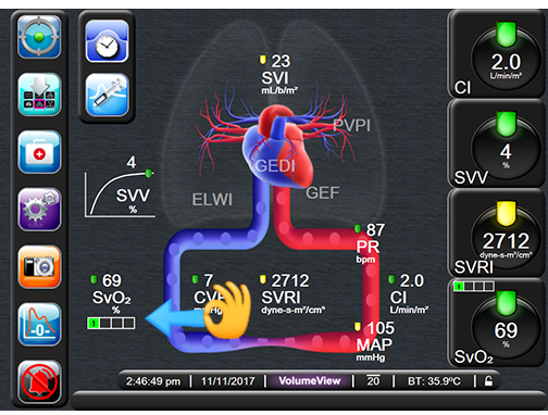 EV1000- Flotrac, volumeveiw, Presep setting방법 : 네이버 블로그