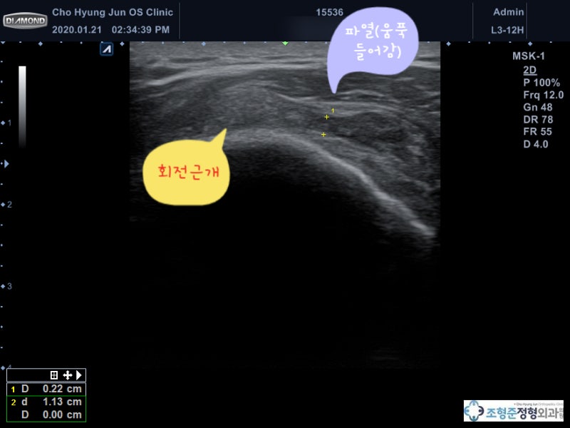 조형준정형외과 개방병원 활용기 회전근개 파열 봉합술 네이버 블로그