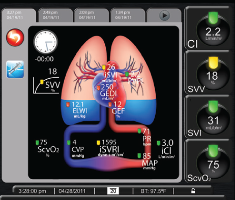 EV1000- Flotrac, volumeveiw, Presep setting방법 : 네이버 블로그