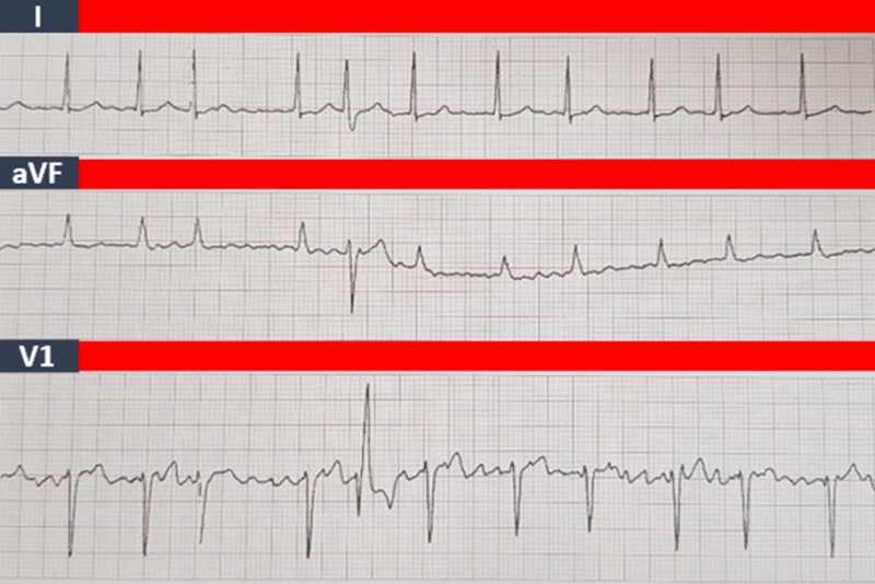 이상/편위전도(Aberrant conduction, aberrancy) 심전도 이해 : 네이버 블로그