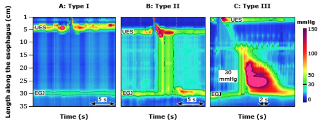 Achalasia High Resolution Manometry