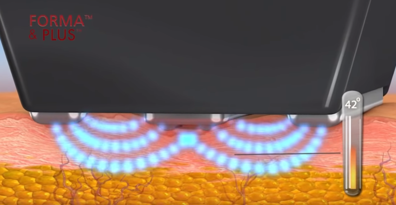 인모드 (INMODE), Mini fx, Forma - 반포 피부과, 방배 피부과 : 네이버 블로그