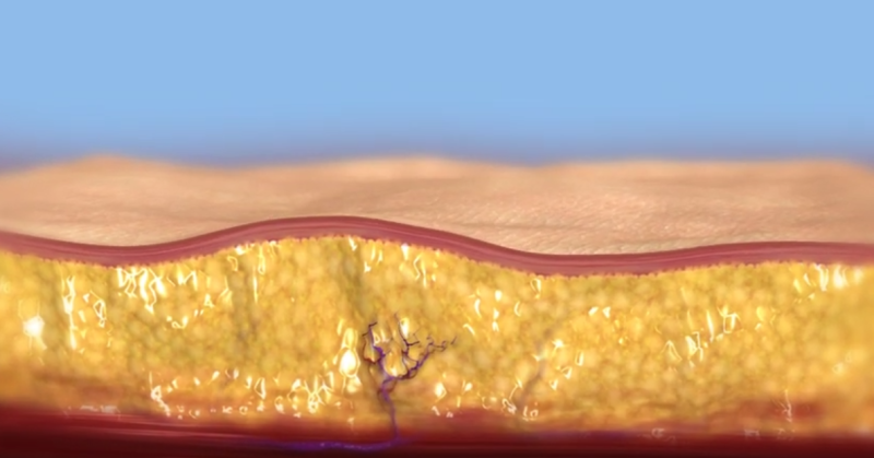 인모드 (INMODE), Mini fx, Forma - 반포 피부과, 방배 피부과 : 네이버 블로그