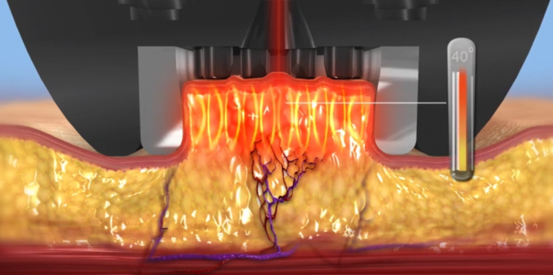 인모드 (INMODE), Mini fx, Forma - 반포 피부과, 방배 피부과 : 네이버 블로그