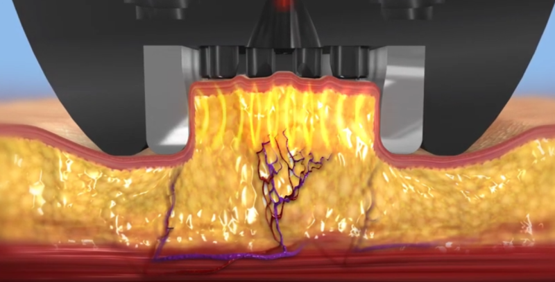 인모드 (INMODE), Mini fx, Forma - 반포 피부과, 방배 피부과 : 네이버 블로그