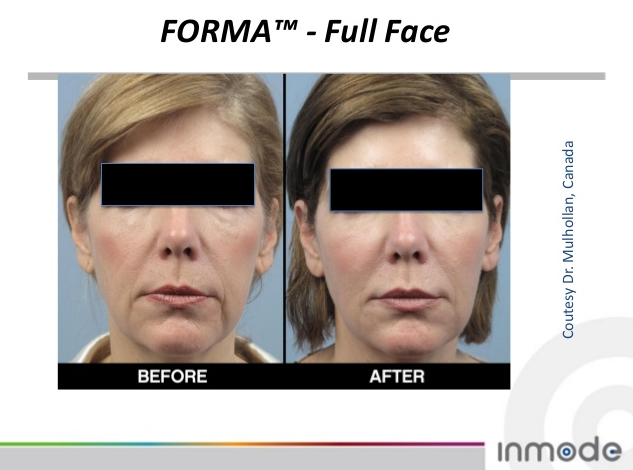 인모드 (INMODE), Mini fx, Forma - 반포 피부과, 방배 피부과 : 네이버 블로그