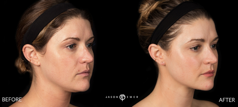 인모드 (INMODE), Mini fx, Forma - 반포 피부과, 방배 피부과 : 네이버 블로그