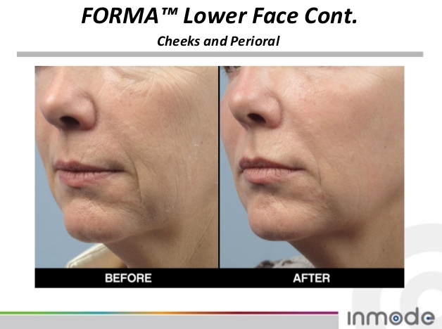 인모드 (INMODE), Mini fx, Forma - 반포 피부과, 방배 피부과 : 네이버 블로그