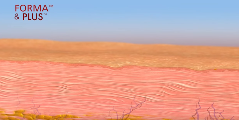 인모드 (INMODE), Mini fx, Forma - 반포 피부과, 방배 피부과 : 네이버 블로그