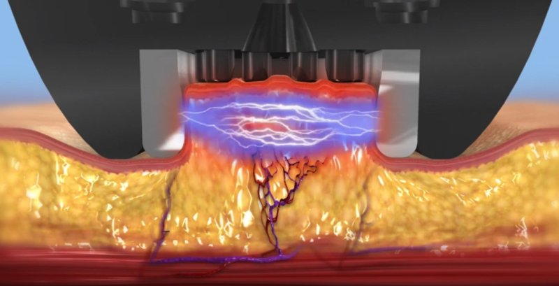 인모드 (INMODE), Mini fx, Forma - 반포 피부과, 방배 피부과 : 네이버 블로그