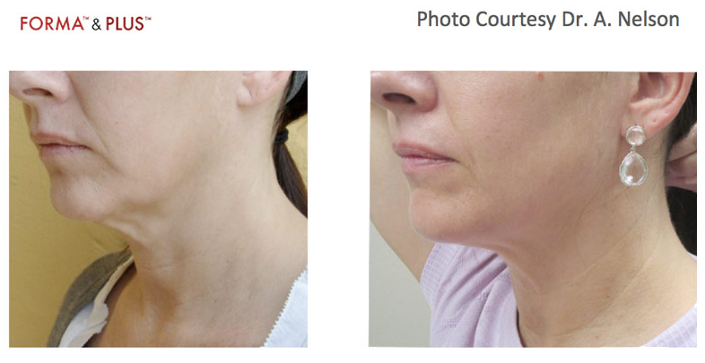 인모드 (INMODE), Mini fx, Forma - 반포 피부과, 방배 피부과 : 네이버 블로그