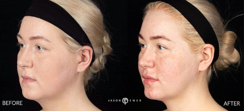 인모드 (INMODE), Mini fx, Forma - 반포 피부과, 방배 피부과 : 네이버 블로그