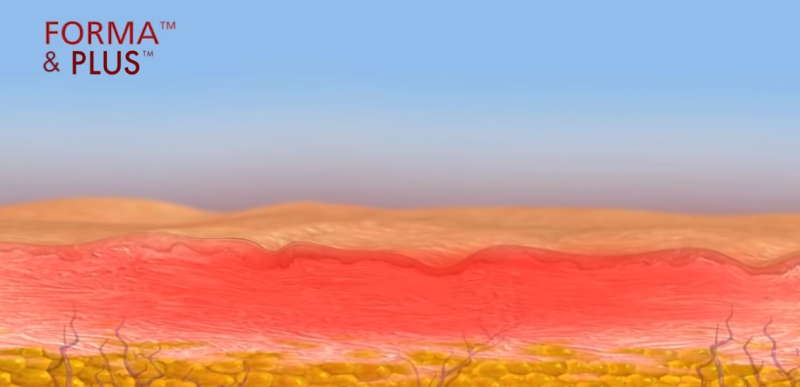 인모드 (INMODE), Mini fx, Forma - 반포 피부과, 방배 피부과 : 네이버 블로그