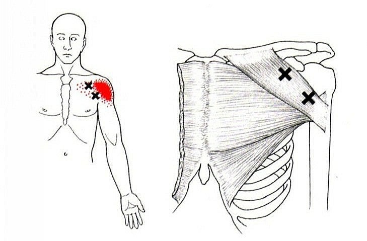 대흉근pectoralis Major 큰가슴근 대흉근 해부학가슴운동 가슴스트레칭 가슴통증 팔통증 팔저림 네이버 블로그
