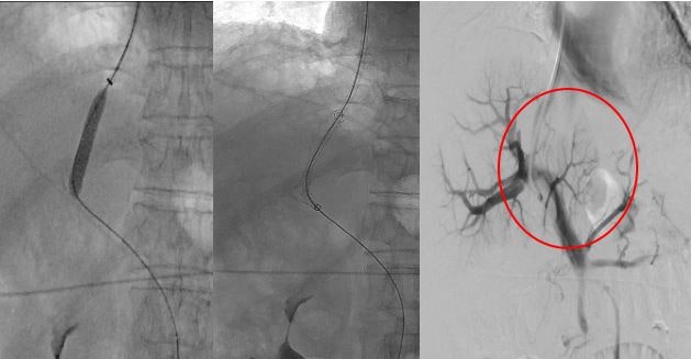 PARTO(Plug Assisted Retrograde Transvenous Obliteration) 역행성정맥통과위정맥류폐색술 ...