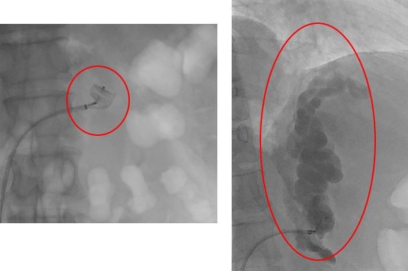 PARTO(Plug Assisted Retrograde Transvenous Obliteration) 역행성정맥통과위정맥류폐색술 ...
