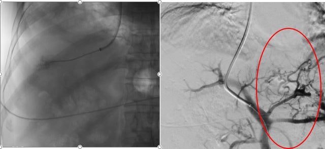 PARTO(Plug Assisted Retrograde Transvenous Obliteration) 역행성정맥통과위정맥류폐색술 ...