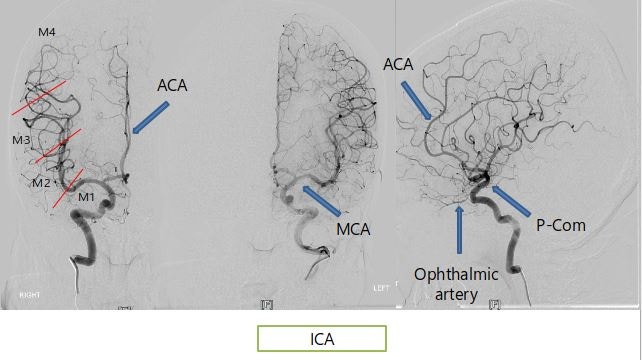 뇌혈관(Cerebral Artery) 해부학, 뇌혈관 조영술, 뇌혈관 중재적 시술 : 네이버 블로그