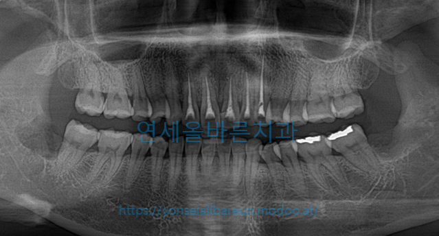 용인시내사랑니발치 연세올바른치과안전한사랑니발치ct촬영 네이버 블로그