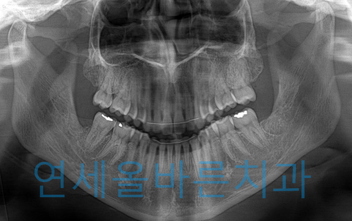 용인시내사랑니발치 연세올바른치과안전한사랑니발치ct촬영 네이버 블로그