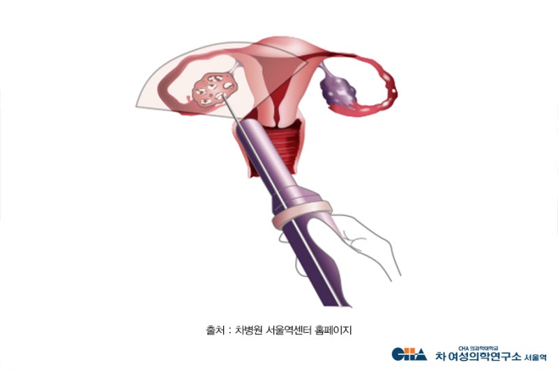 차병원 서울역센터 단계별로 알아보는 시험관아기 시술 과정 시술 방법 소요 시간 주의사항 네이버 블로그