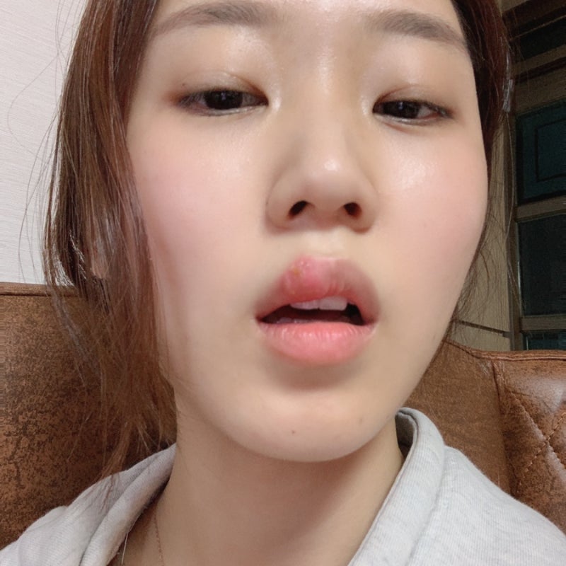 입술 구순 포진 헤르페스 연고 및 치유 기간포진 낫는 과정 메노바 크림 후기 네이버 블로그