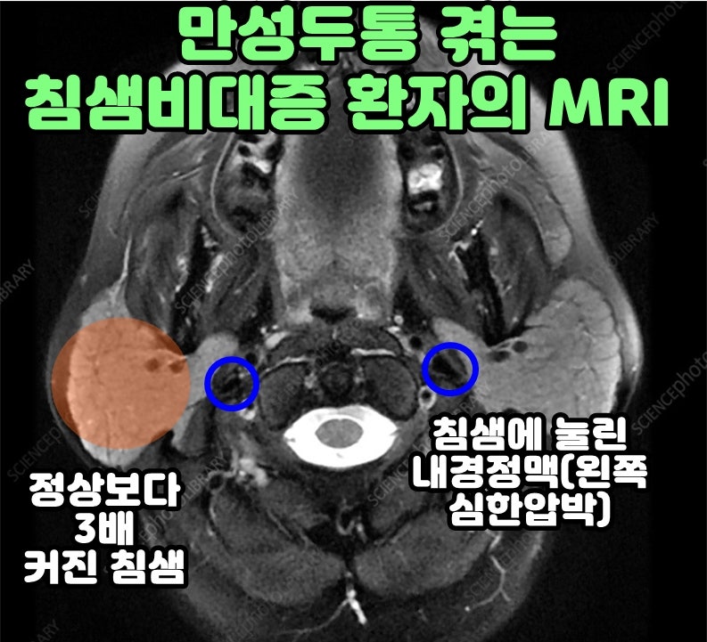 귀밑몽우리 침샘비대증 치료 턱관절치료냐 턱신경통치료냐 침샘축소 네이버 블로그