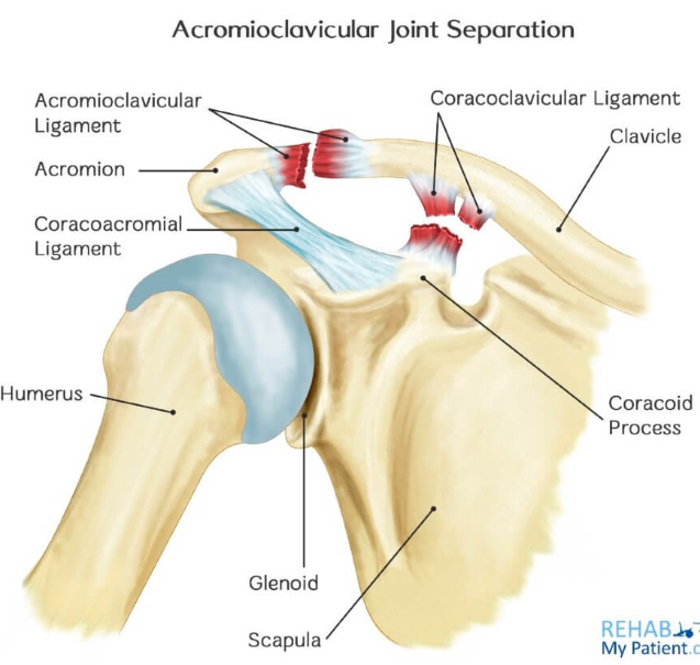 ORIF : ACJ (Acromioclavicular joint, 견봉쇄골 관절) : 네이버 블로그