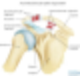 ORIF : ACJ (Acromioclavicular joint, 견봉쇄골 관절) : 네이버 블로그
