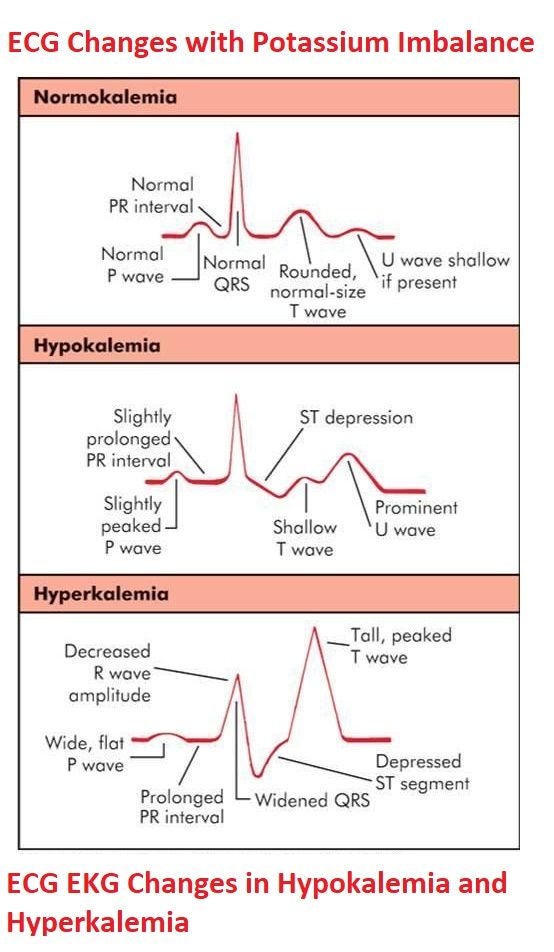 Electrolyte abnormalities에서 EKG의 변화 : 네이버 블로그